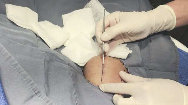 Watch Dr. Pimple Popper This is Zit: Lessons in Lipomas S7 Eundefined ...